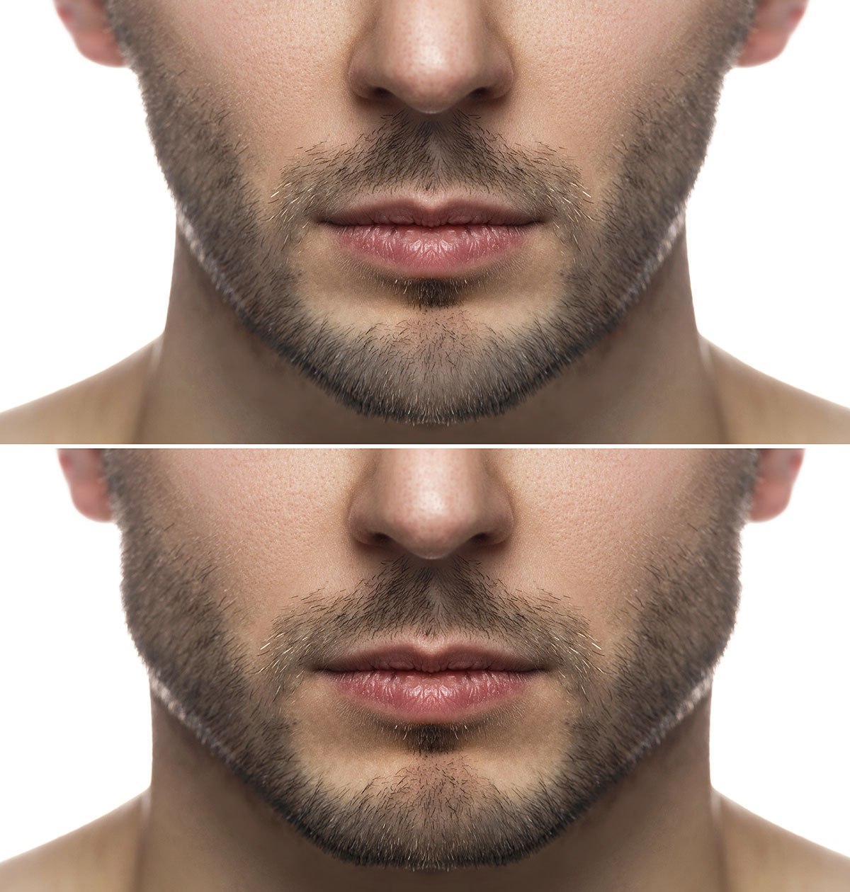 Chin Implants in Sacramento, CA | Folsom Plastic Surgery